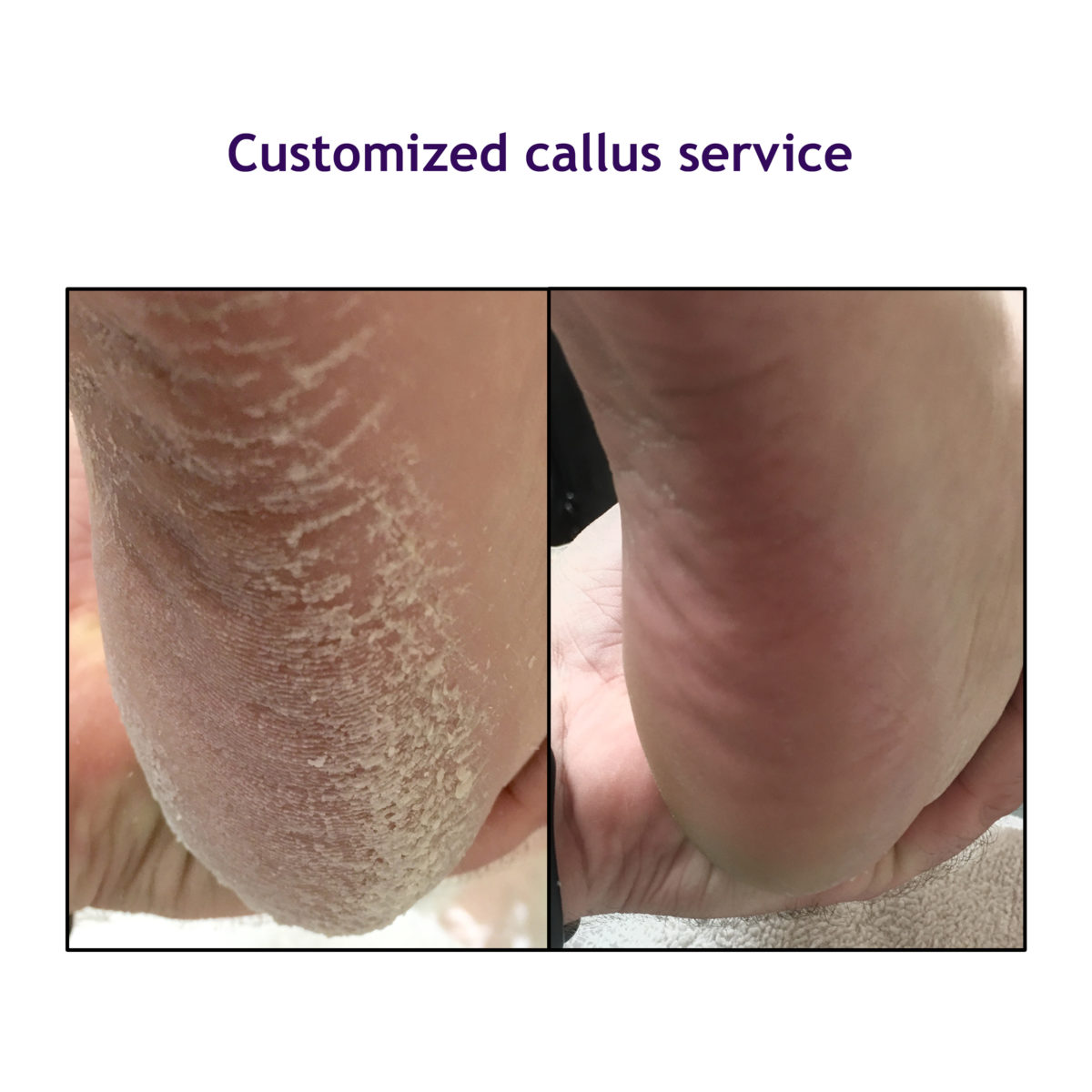 3 Customized Services for Callus Care! | Centre for Beauty